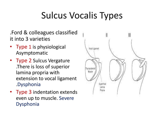 Sulcus vocalis | PPTX | Ear, Nose and Throat Conditions | Diseases and ...