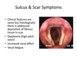 Sulcus vocalis | PPTX | Ear, Nose and Throat Conditions | Diseases and ...