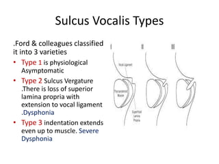 Sulcus vocalis | PPT