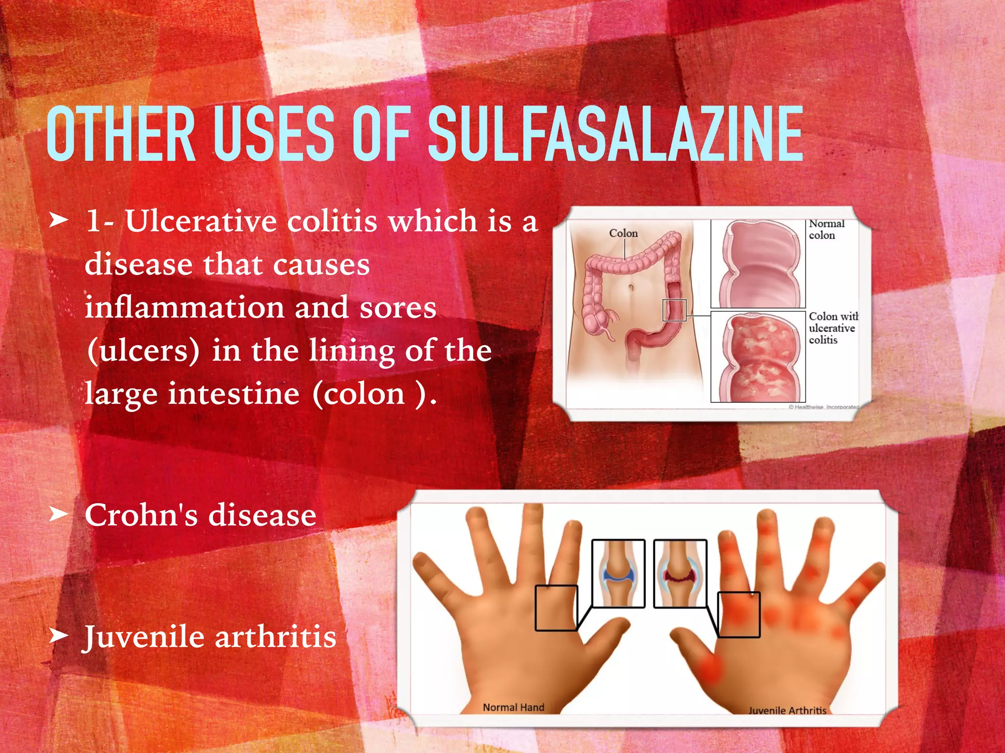 Sulfasalazine | PDF