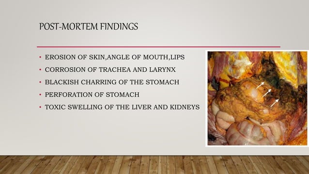 Sulphuric acid poisoning | PPT