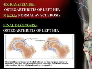 SUMAYYA AFREEN 18-OA OF LEFT HIP.pptxfvccc | PPTX