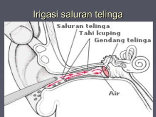 Sumbatan dan irigasi telinga | PPT