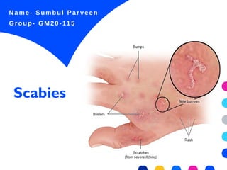Nabshsbsjsbebjeb IWS dermatology Scabies.pptx