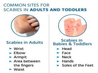 Nabshsbsjsbebjeb IWS dermatology Scabies.pptx