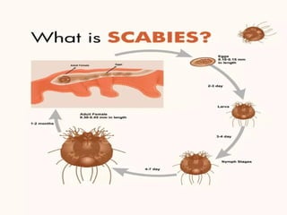 Nabshsbsjsbebjeb IWS dermatology Scabies.pptx