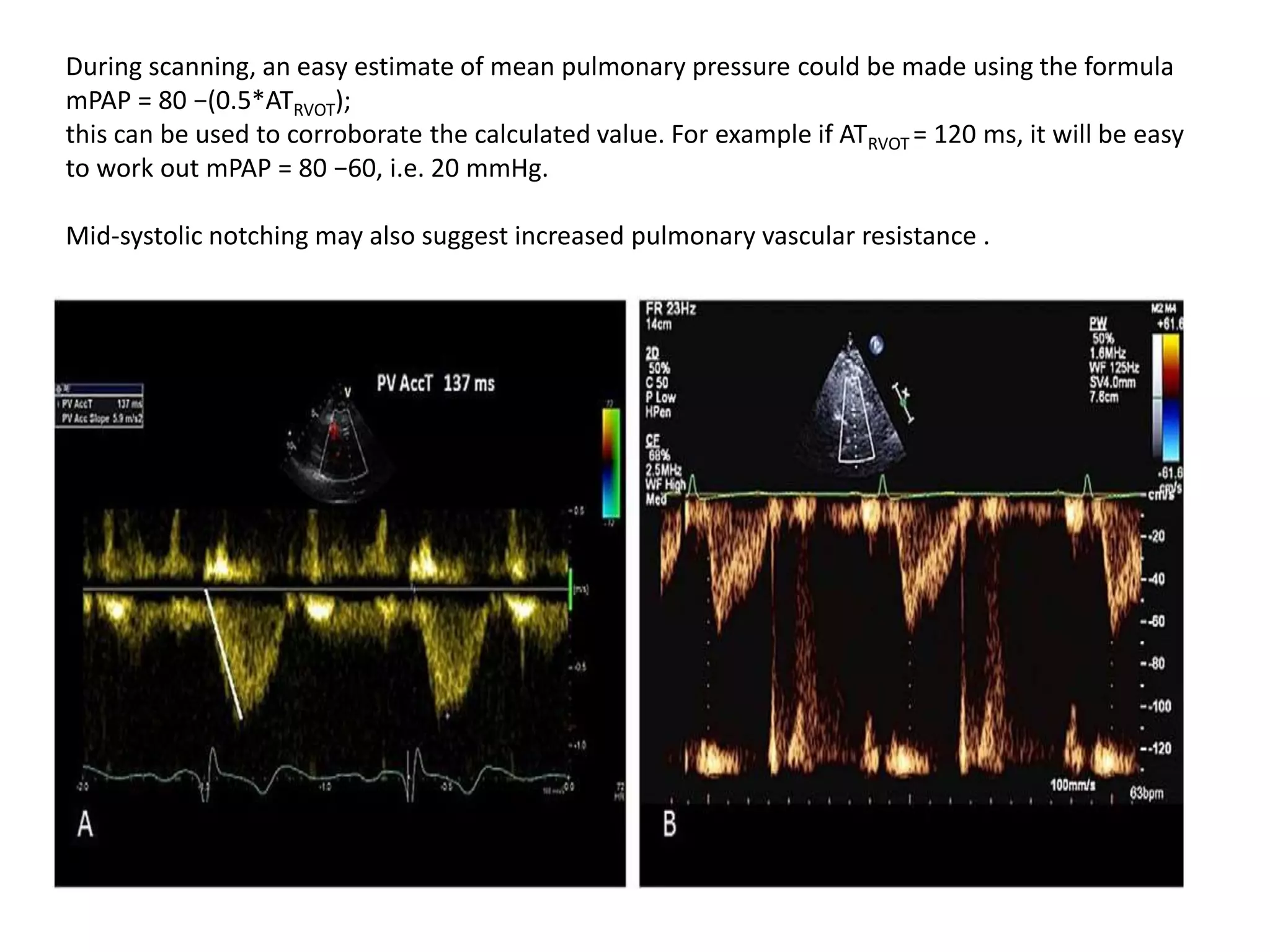 PULMONARY HYPERTENSION | PPTX