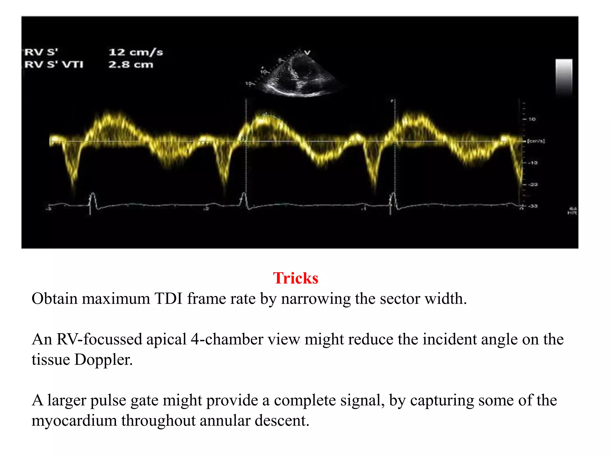 PULMONARY HYPERTENSION | PPTX