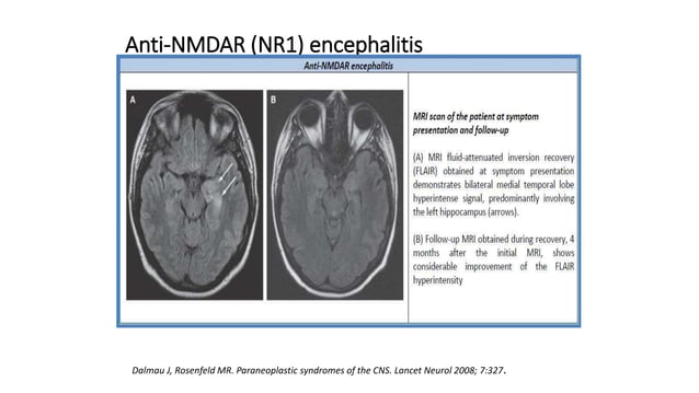 anti NMDA receptor encephalitis - Copy.pptx
