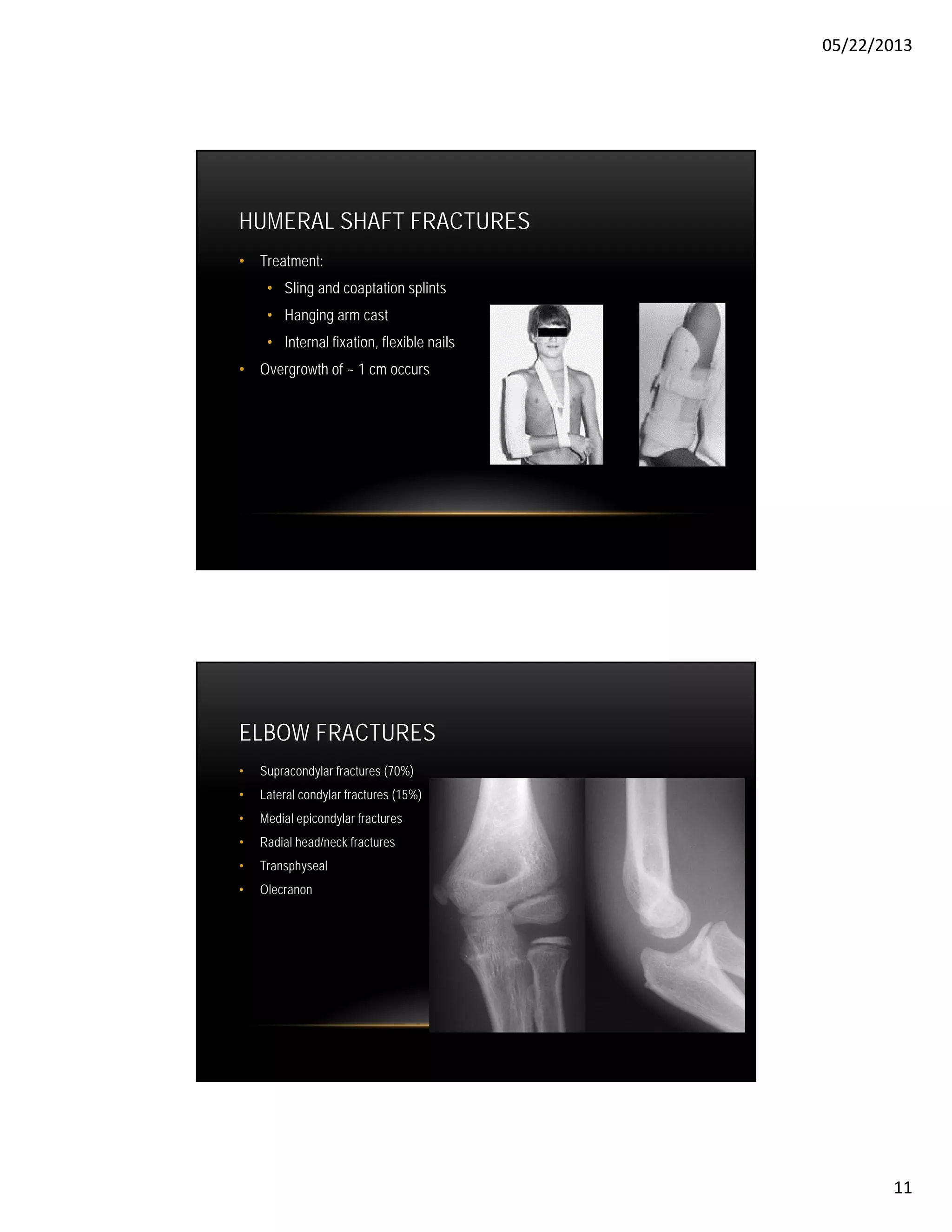 Common Fractures Of Upper Limb | PDF