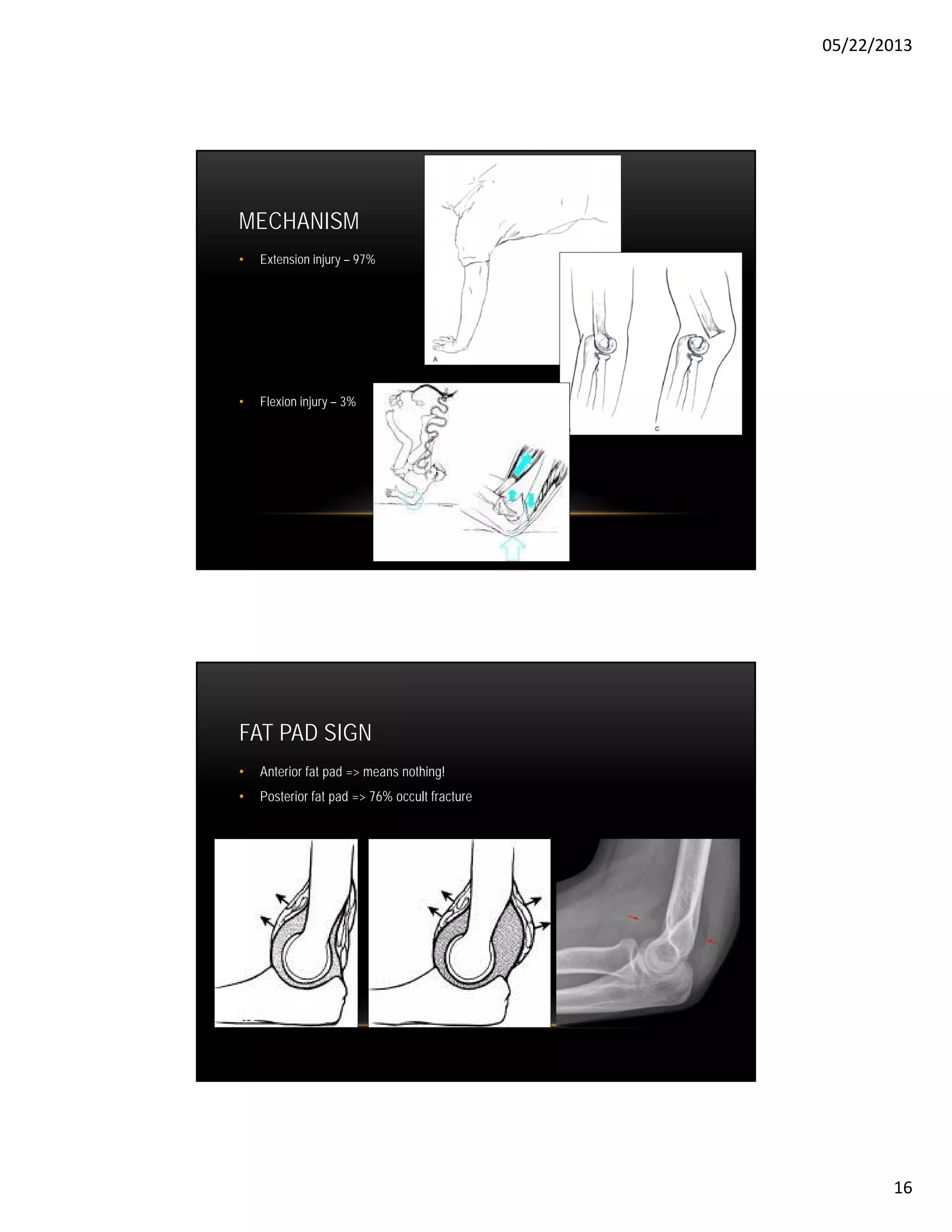 Common Fractures Of Upper Limb | PDF