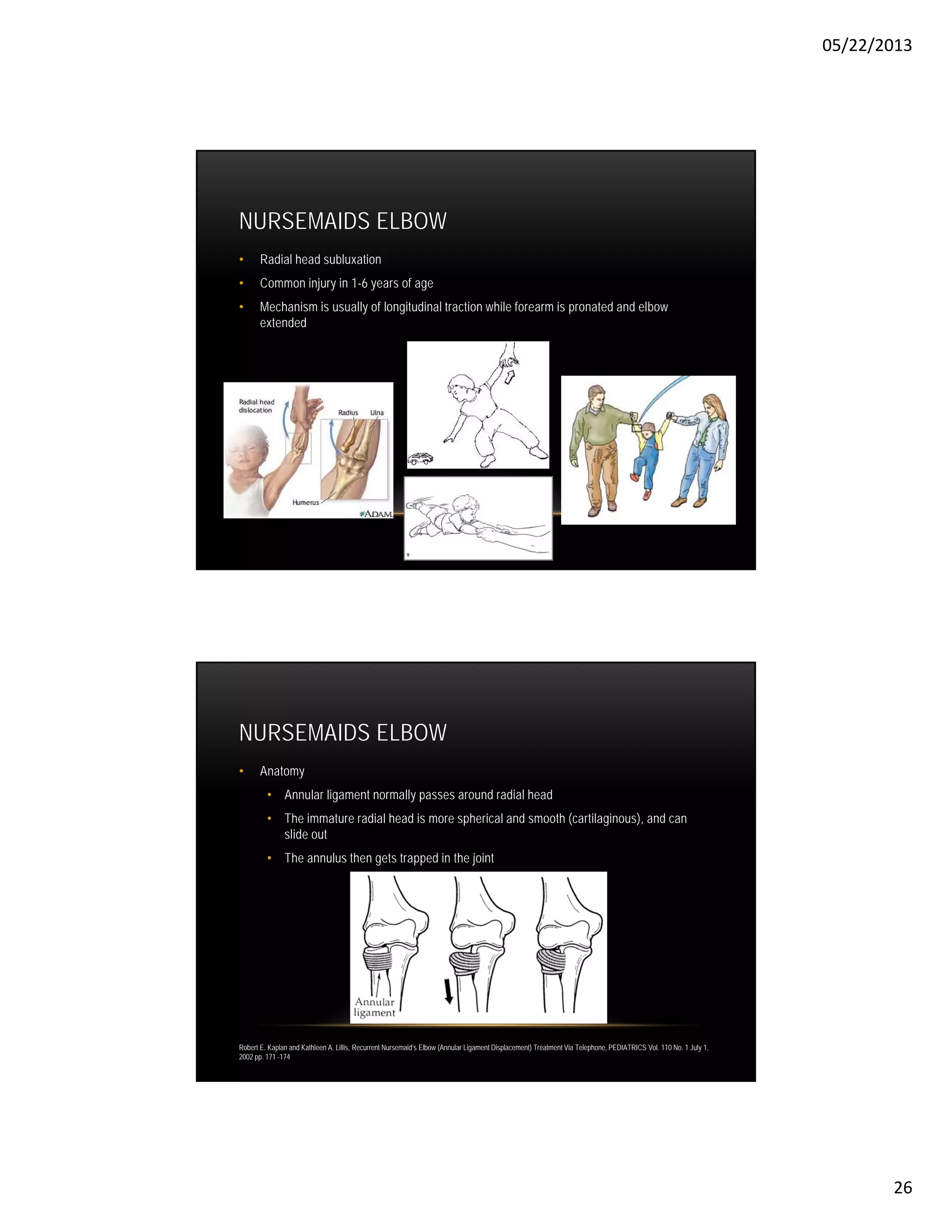 Common Fractures Of Upper Limb | PDF