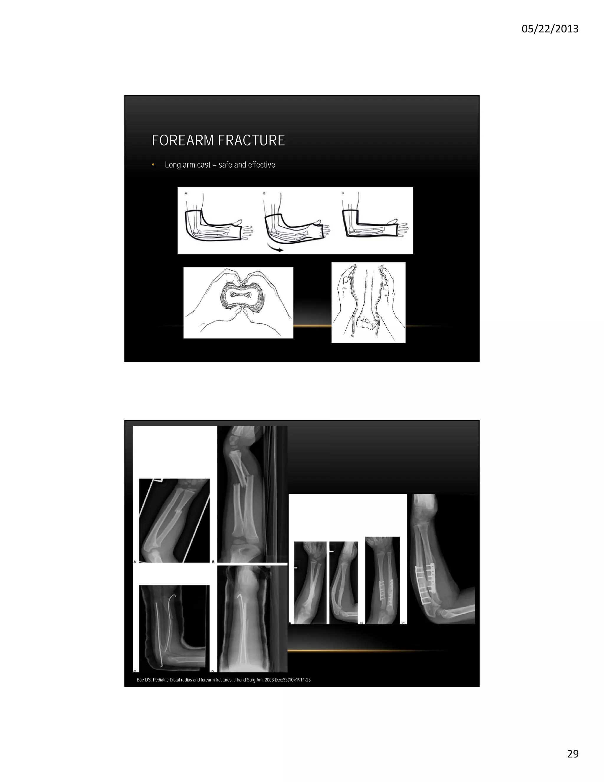 Common Fractures Of Upper Limb | PDF