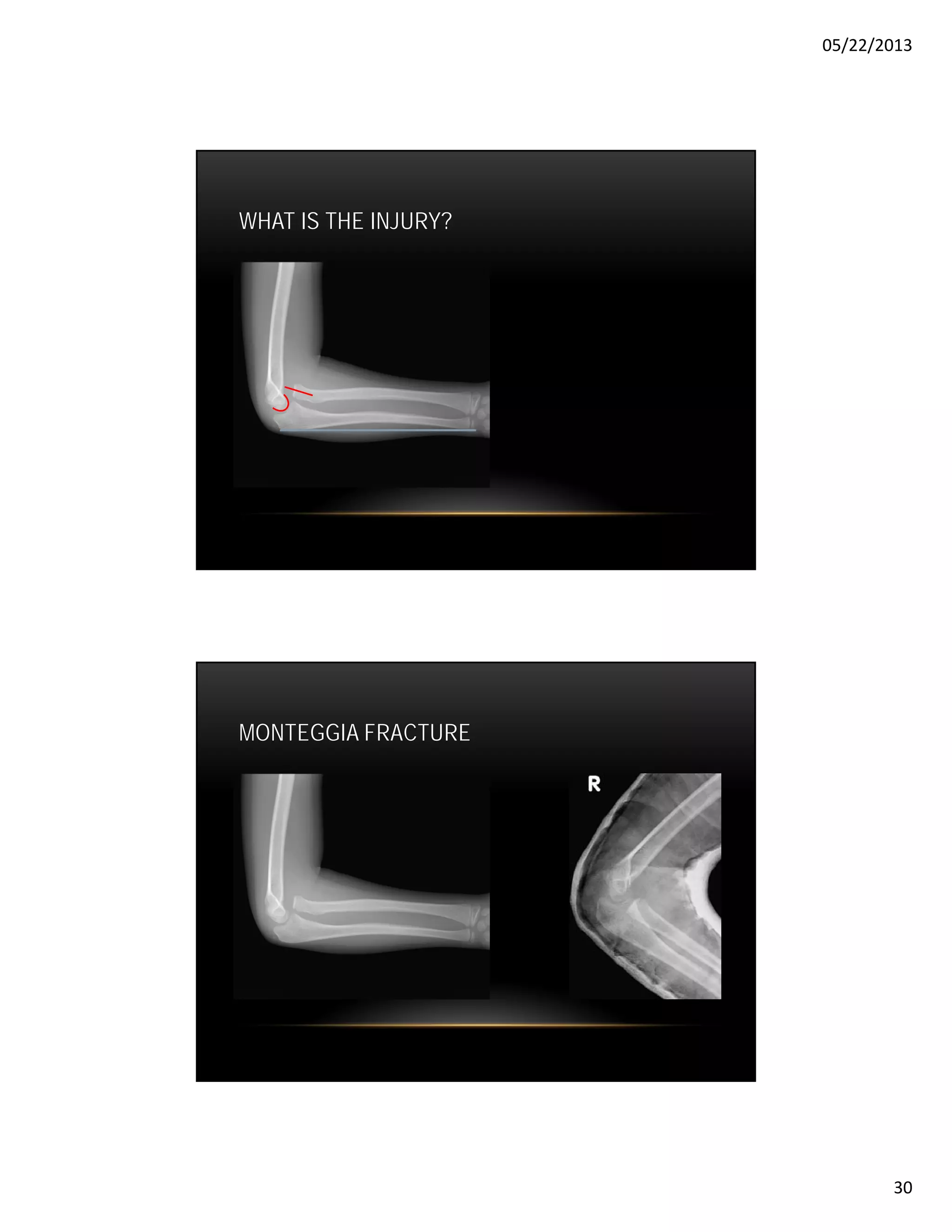 Common Fractures Of Upper Limb | PDF