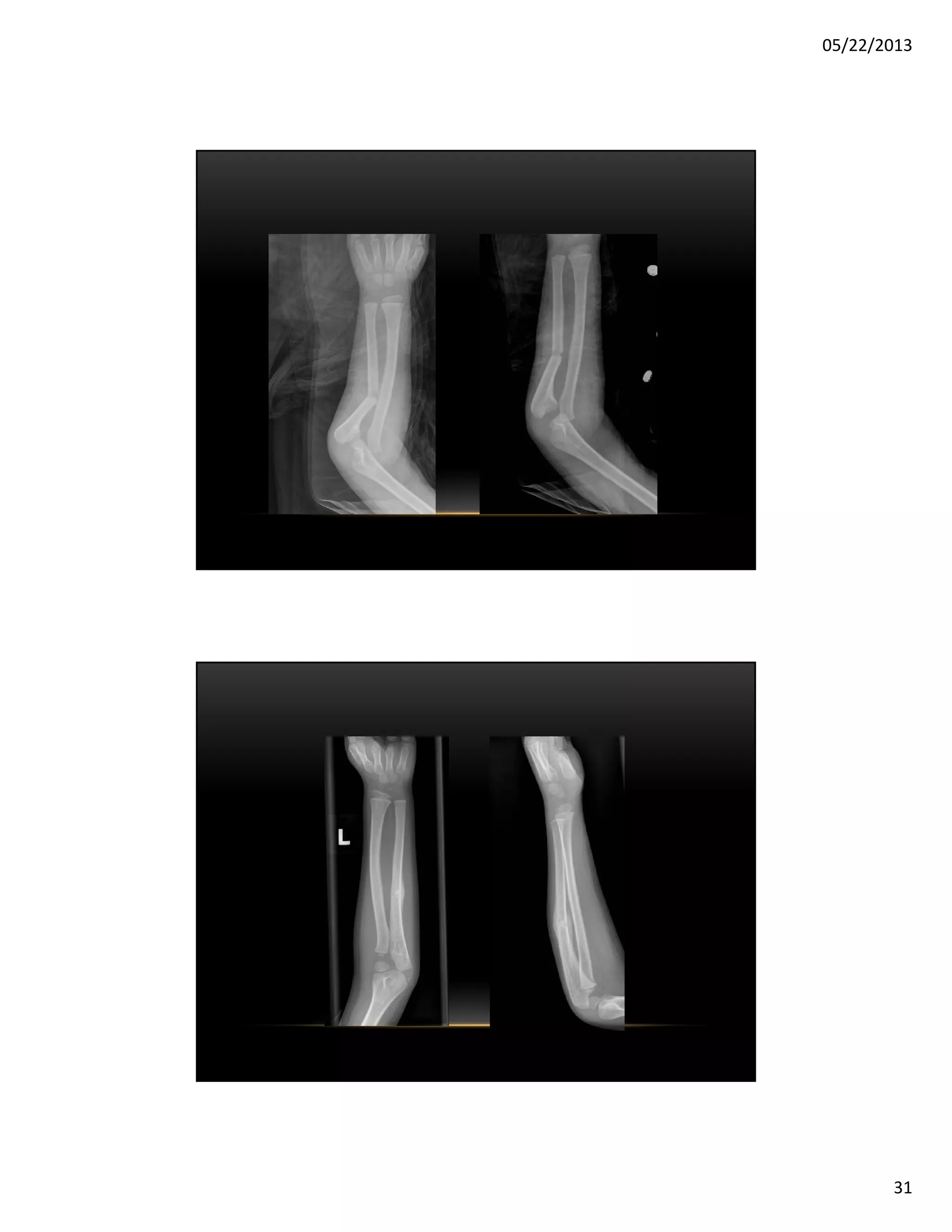 Common Fractures Of Upper Limb | PDF