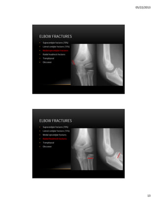 Common Fractures Of Upper Limb | PDF