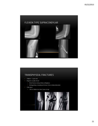 Common Fractures Of Upper Limb | PDF
