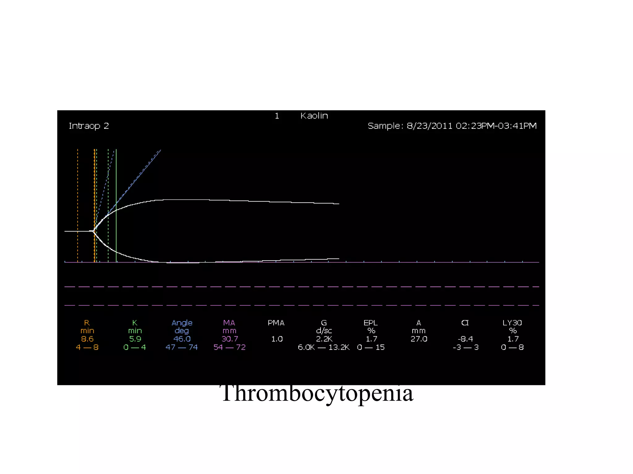 thromboelastography | PPT
