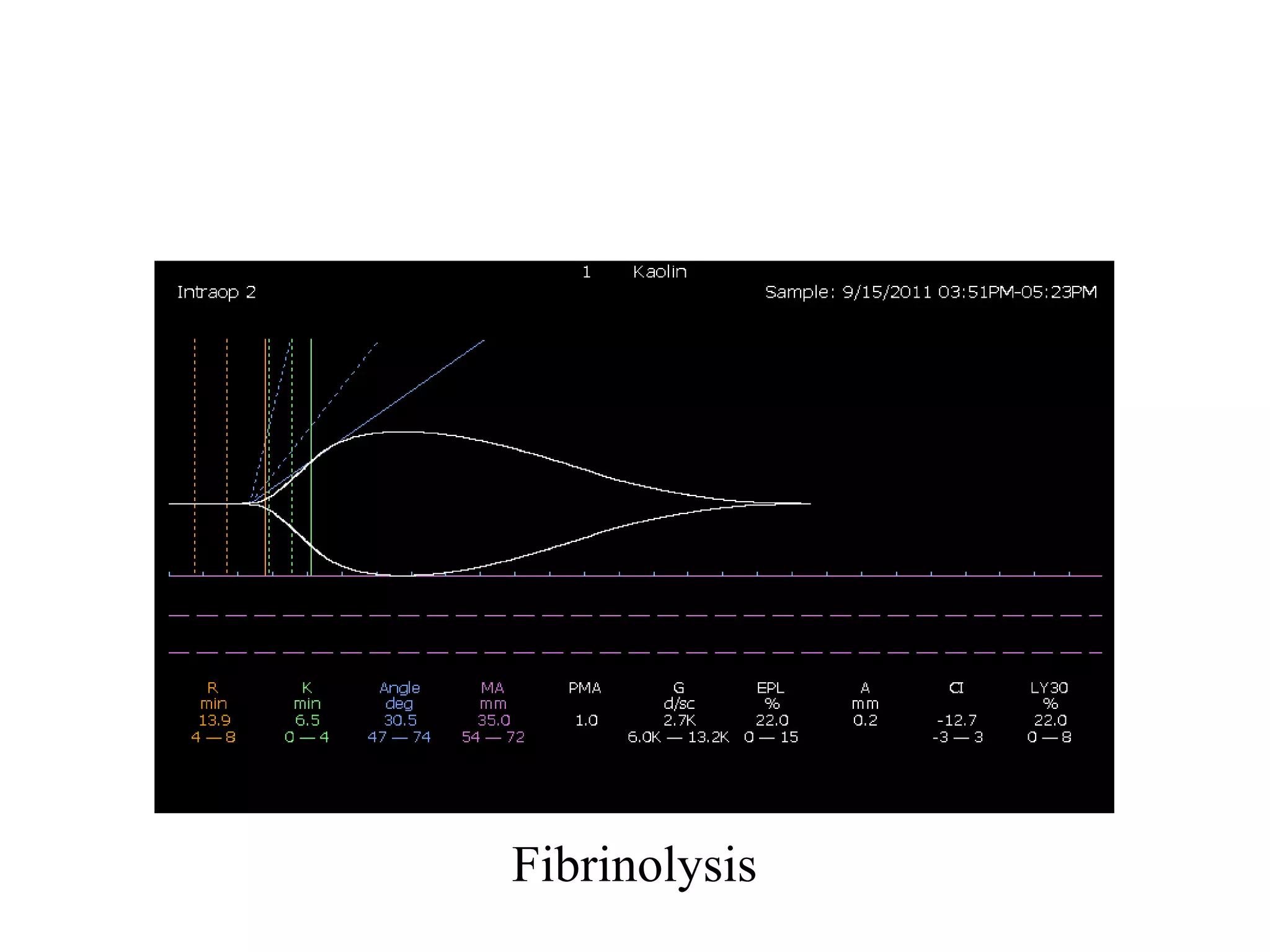 thromboelastography | PPT