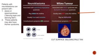 Summary - Neoplasms of infancy and childhood - Asem M. Shadid | PPTX