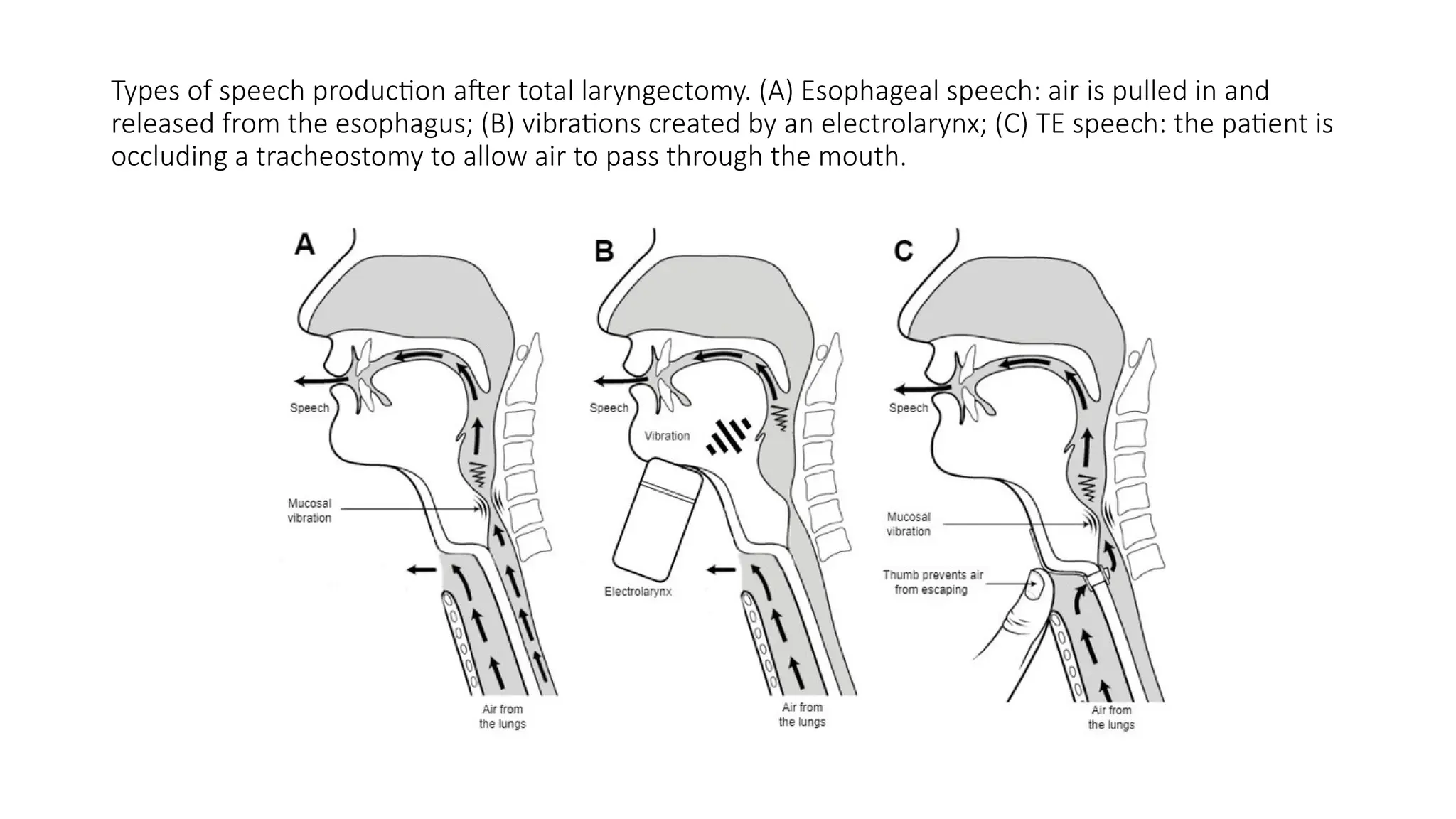 Summary laryngectomy.. post laryngectomy | PPT