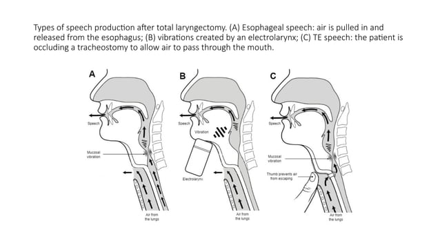 Summary laryngectomy.. post laryngectomy | PPT