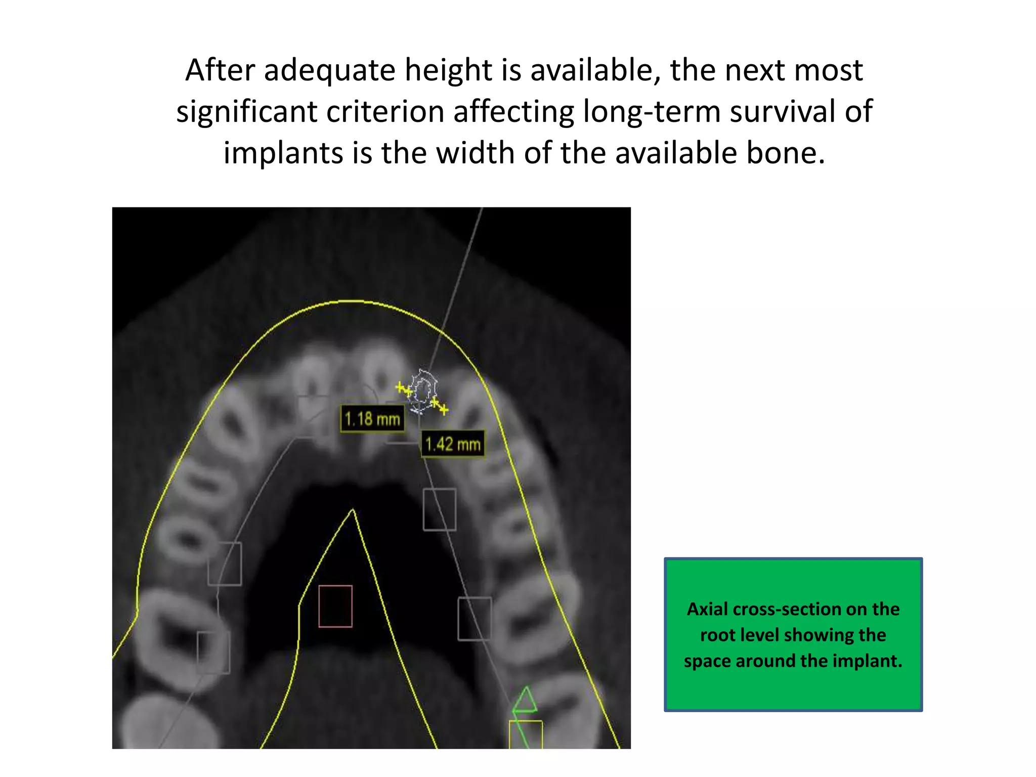 CBCT in Implants- Summary | PPTX