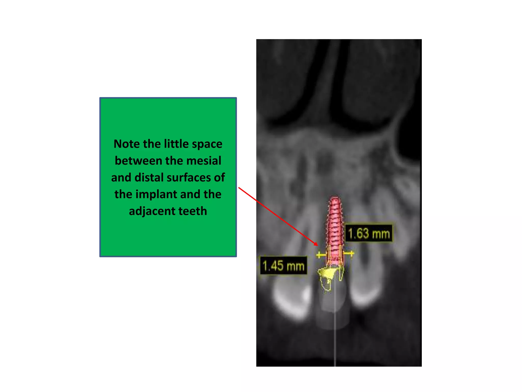 CBCT in Implants- Summary | PPTX