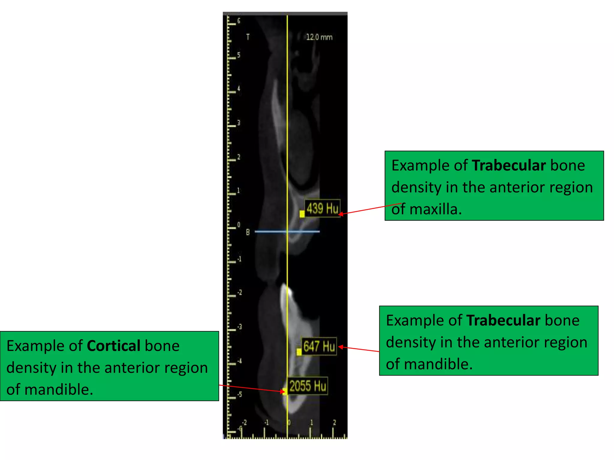 CBCT in Implants- Summary | PPTX