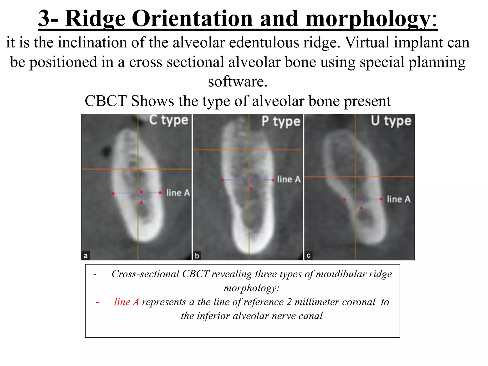 CBCT in Implants- Summary | PPTX