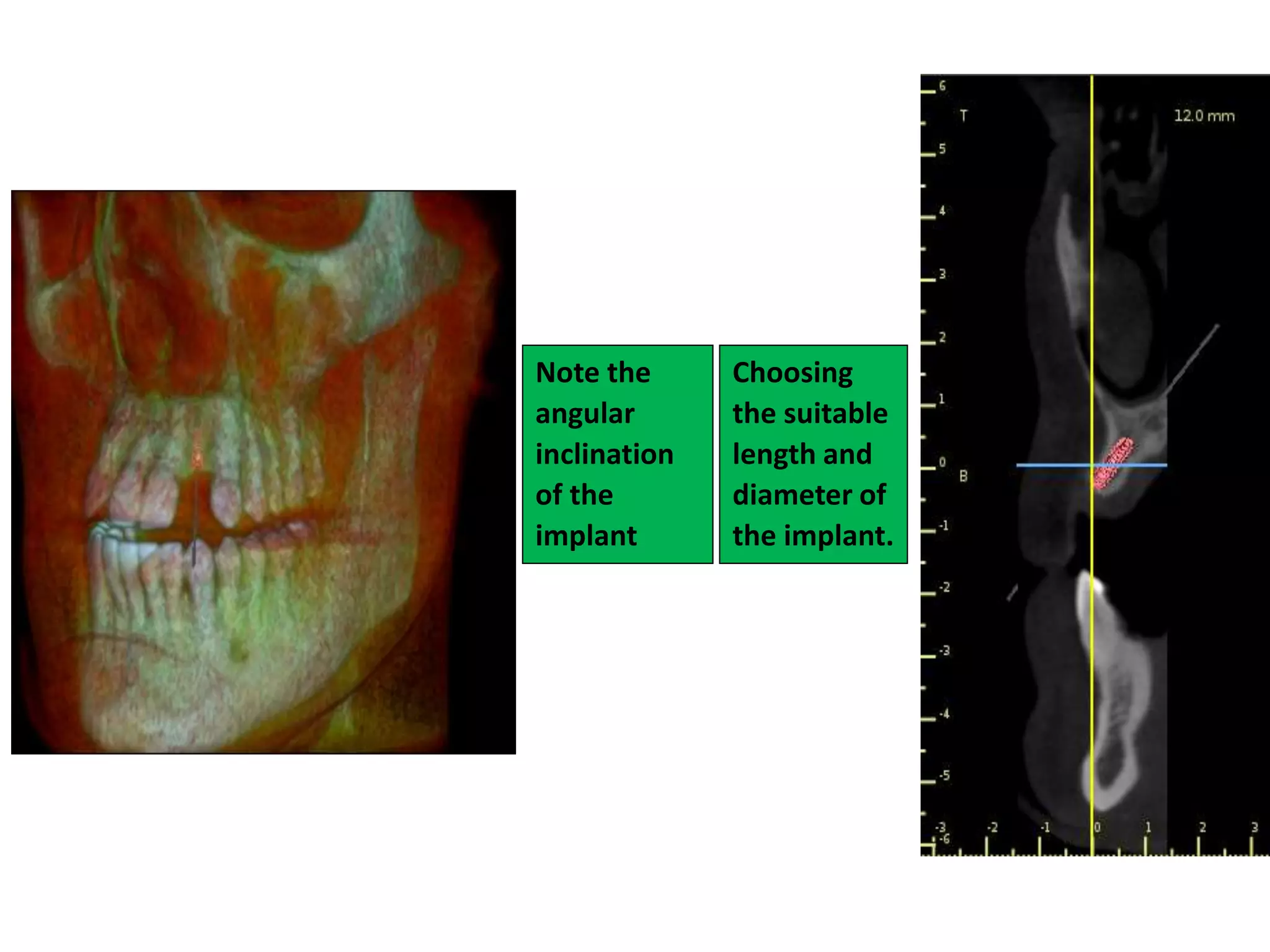 CBCT in Implants- Summary | PPTX
