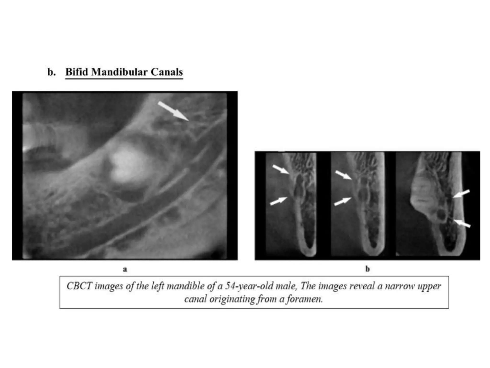 CBCT in Implants- Summary | PPTX