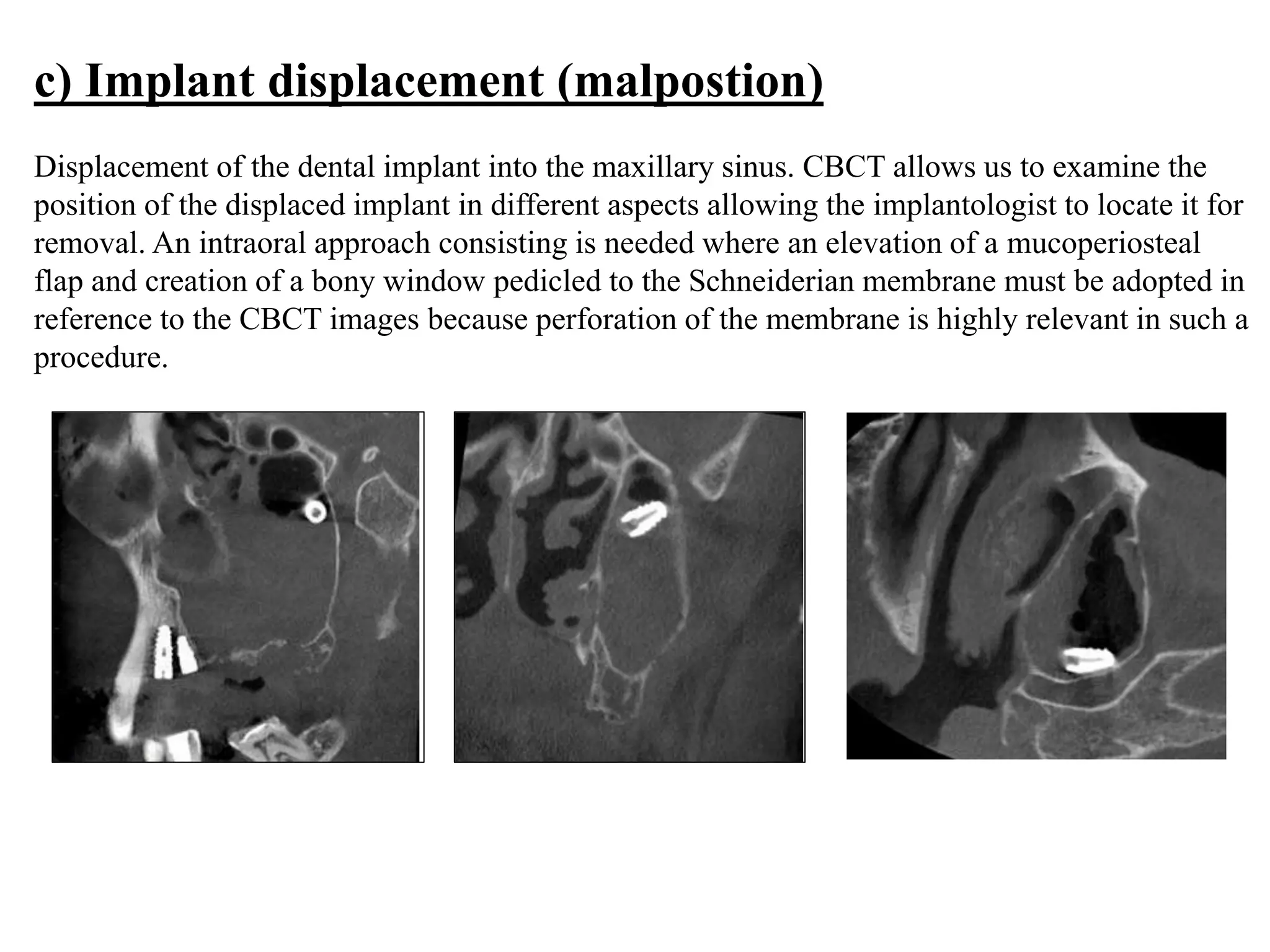 CBCT in Implants- Summary | PPTX