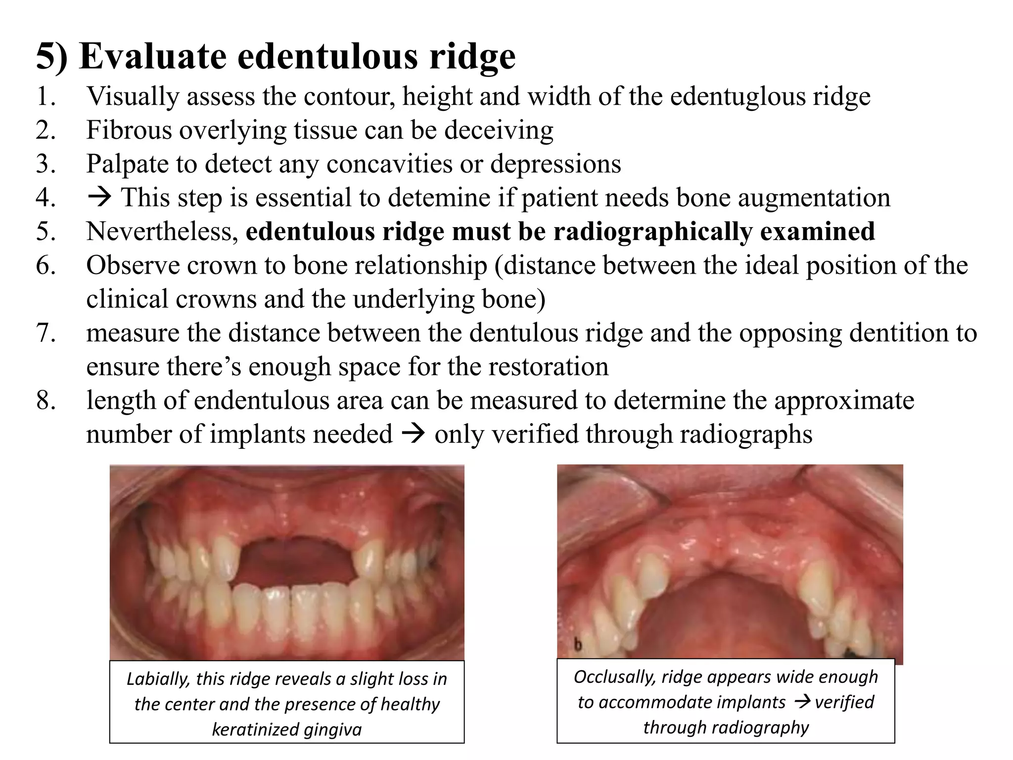 CBCT in Implants- Summary | PPTX