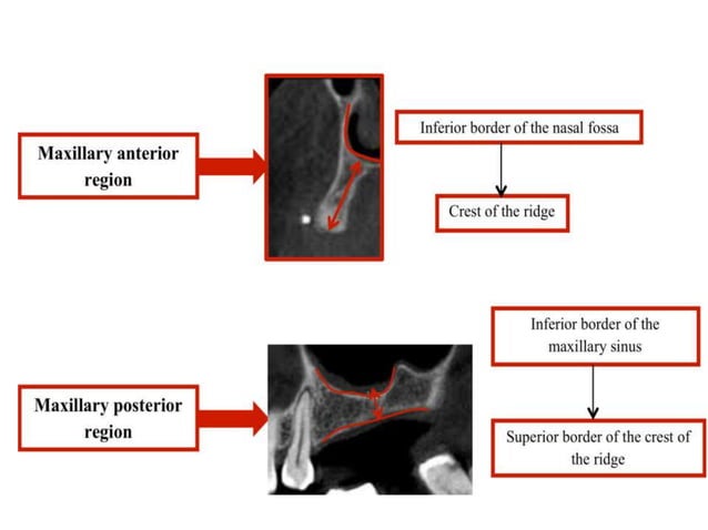 CBCT in Implants- Summary | PPTX | Dental Health | Diseases and Conditions