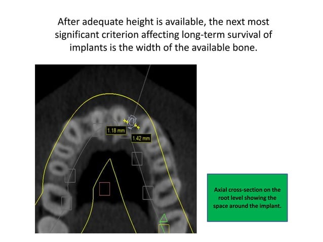 CBCT in Implants- Summary | PPTX | Dental Health | Diseases and Conditions