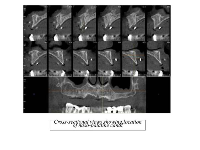 CBCT in Implants- Summary | PPTX | Dental Health | Diseases and Conditions