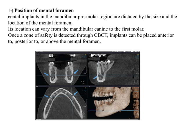 CBCT in Implants- Summary | PPTX | Dental Health | Diseases and Conditions