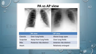 SUMMARY ON HOW TO READ CHEST X-RAY.pdf