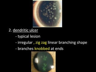 viral corneal ulcer | PPTX