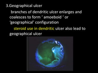 viral corneal ulcer | PPTX