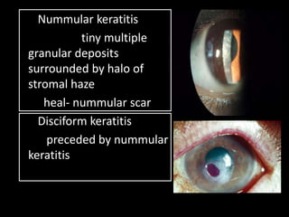 Nummular Keratitis