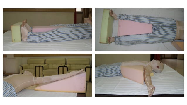 BURN REHABILITATION - a basic presentation on positioning and splinting ...