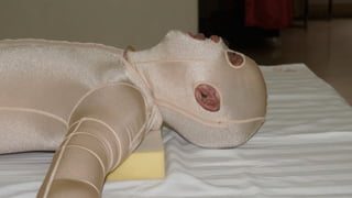 BURN REHABILITATION - a basic presentation on positioning and splinting ...