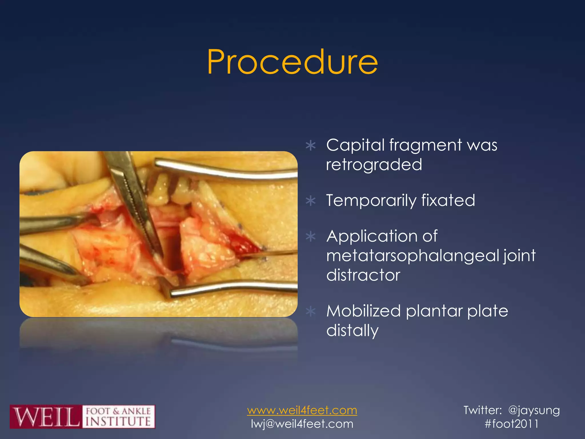 Dorsal Anatomic Plantar Plate Repair | PPT