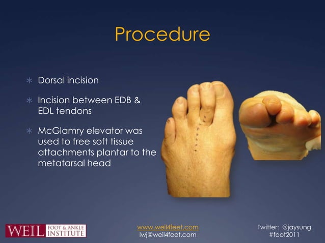 Dorsal Anatomic Plantar Plate Repair