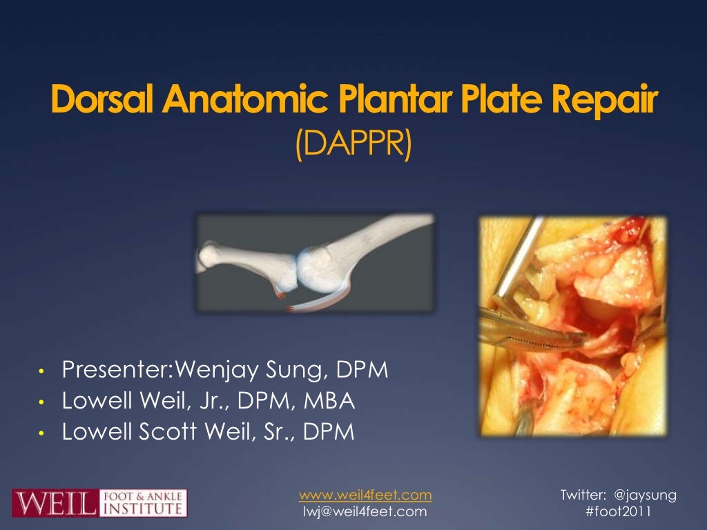 Dorsal Anatomic Plantar Plate Repair