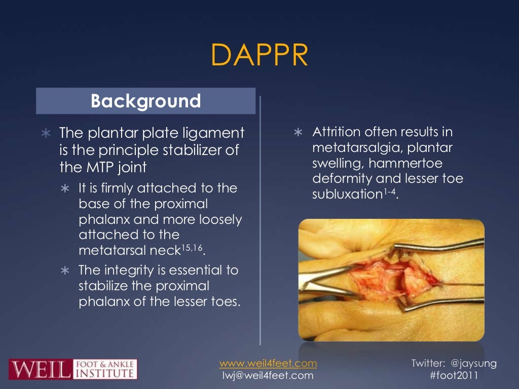 Dorsal Anatomic Plantar Plate Repair