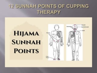 12 sunnah points of cupping or hijama therapy | PPTX | Death, Injury ...
