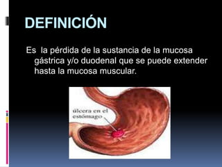 SINDROME ULCEROSO PÈPTICO | PPT